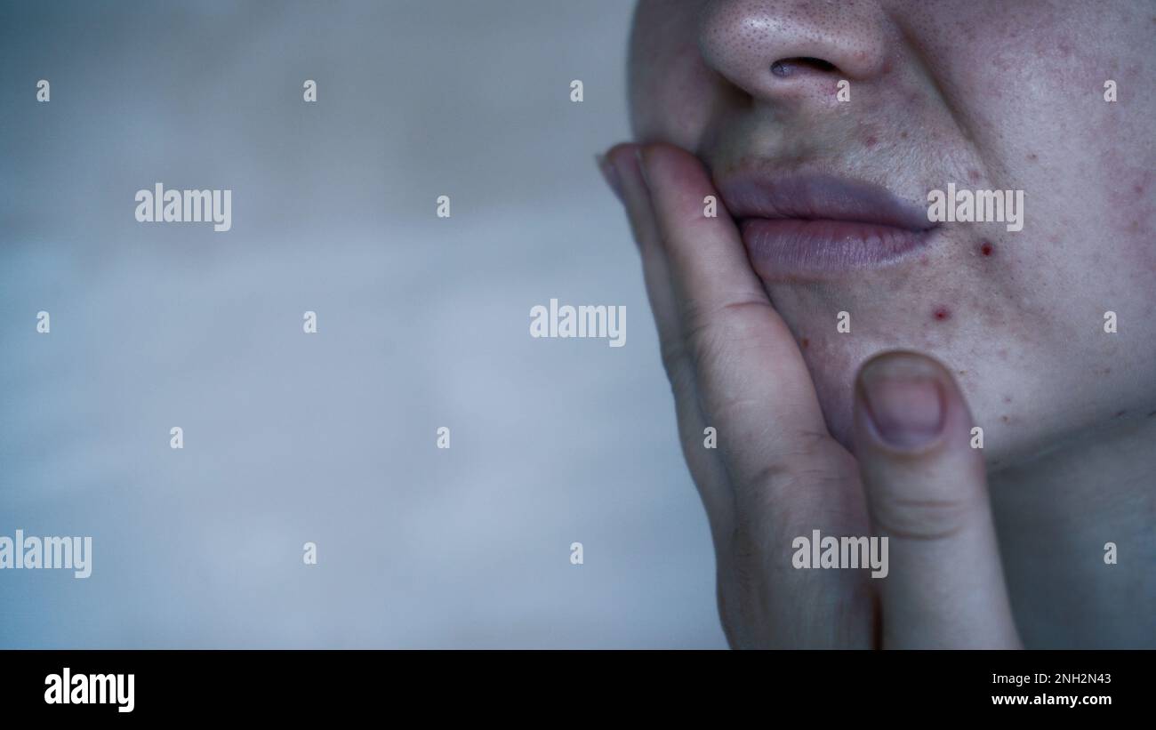 Close up of skin problems, unhealthy skin with acne and pimples. Porous ...