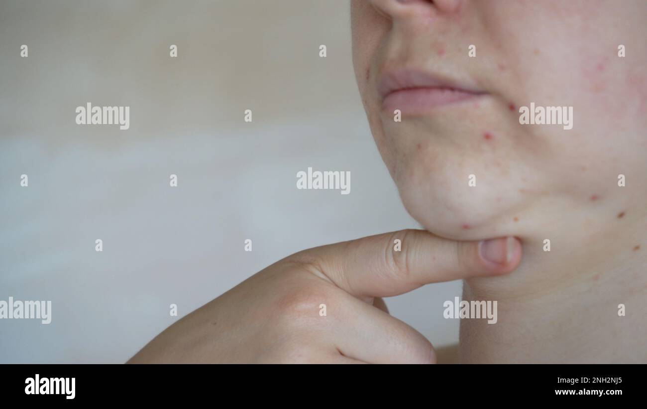 Close up of skin problems, unhealthy skin with acne and pimples. Porous ...