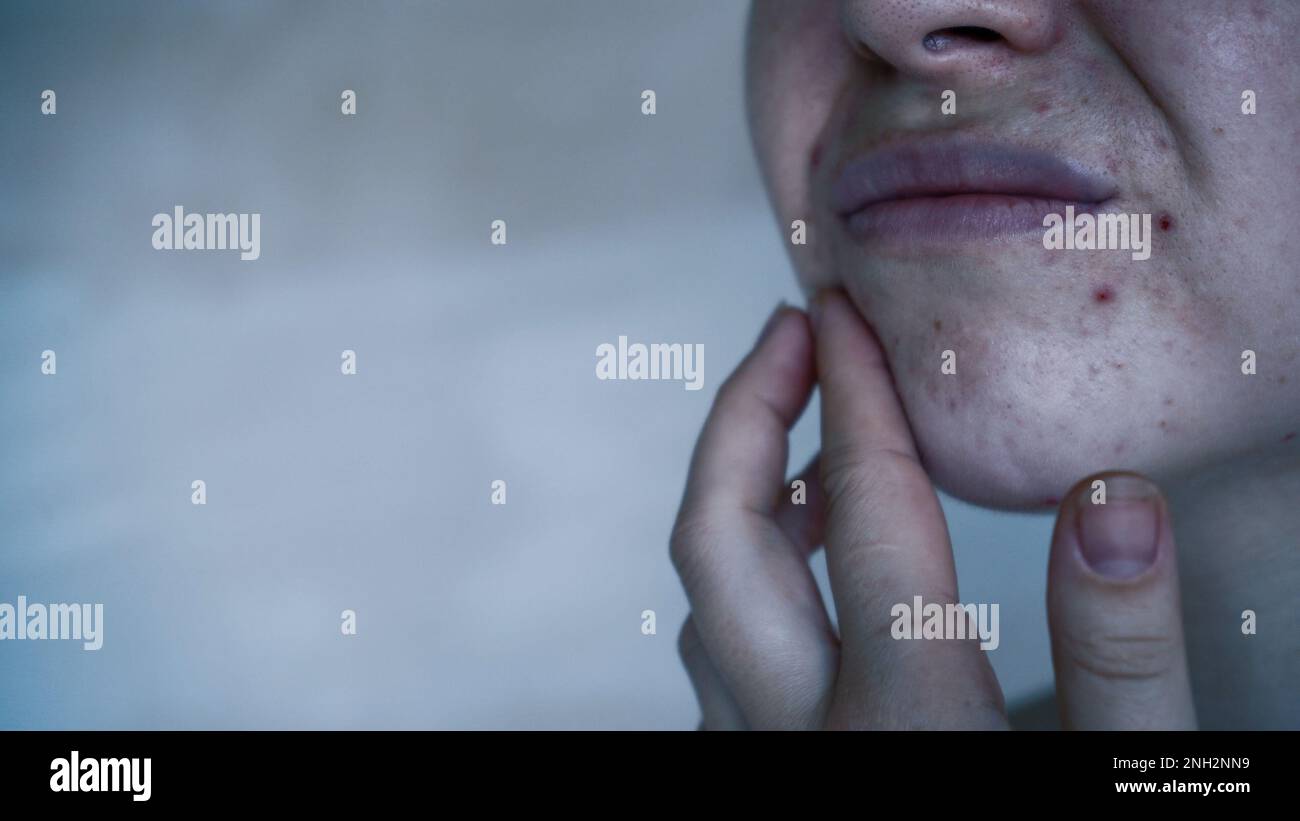 Close up of skin problems, unhealthy skin with acne and pimples. Porous ...