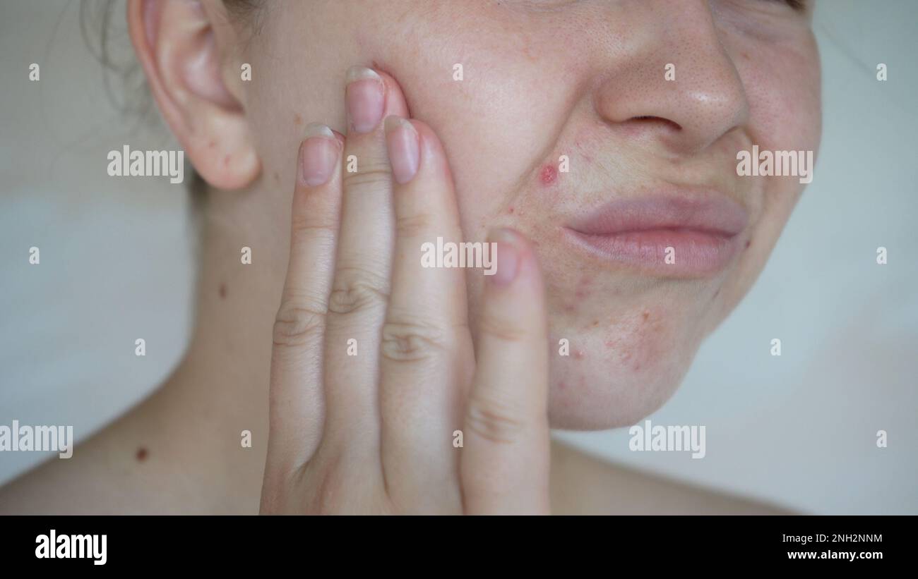 Close up of skin problems, unhealthy skin with acne and pimples. Porous ...
