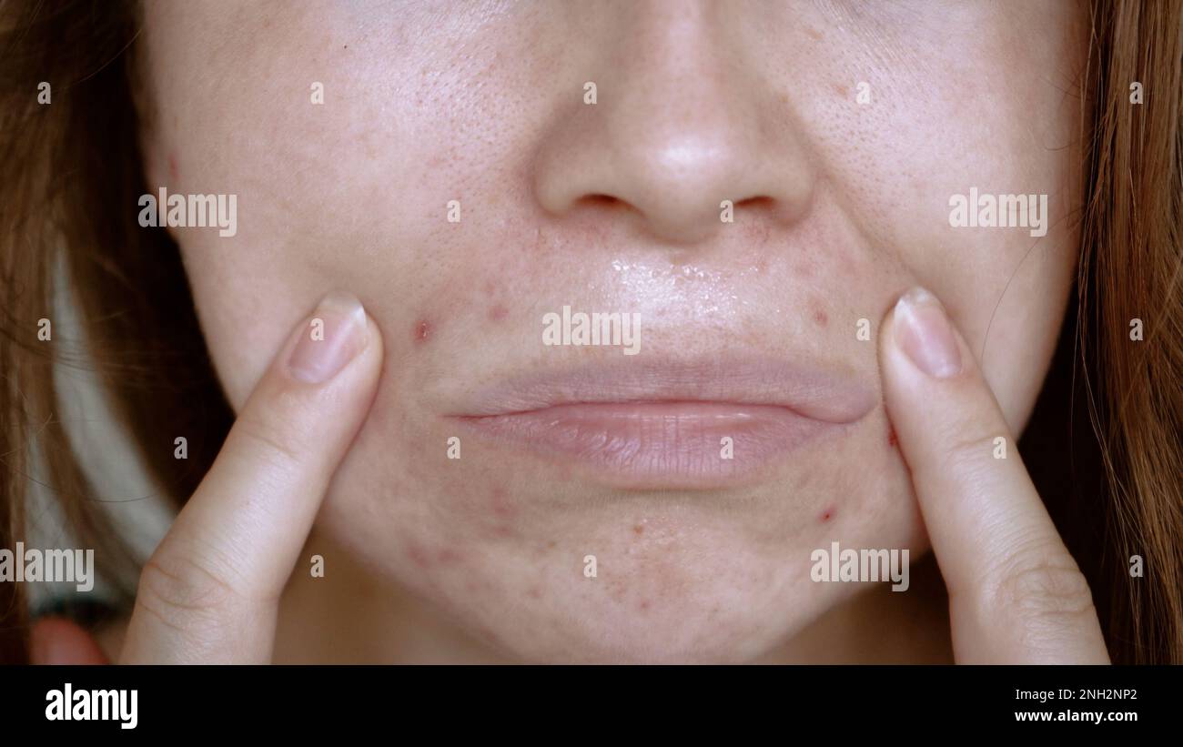 Close up of skin problems, unhealthy skin with acne and pimples. Porous ...