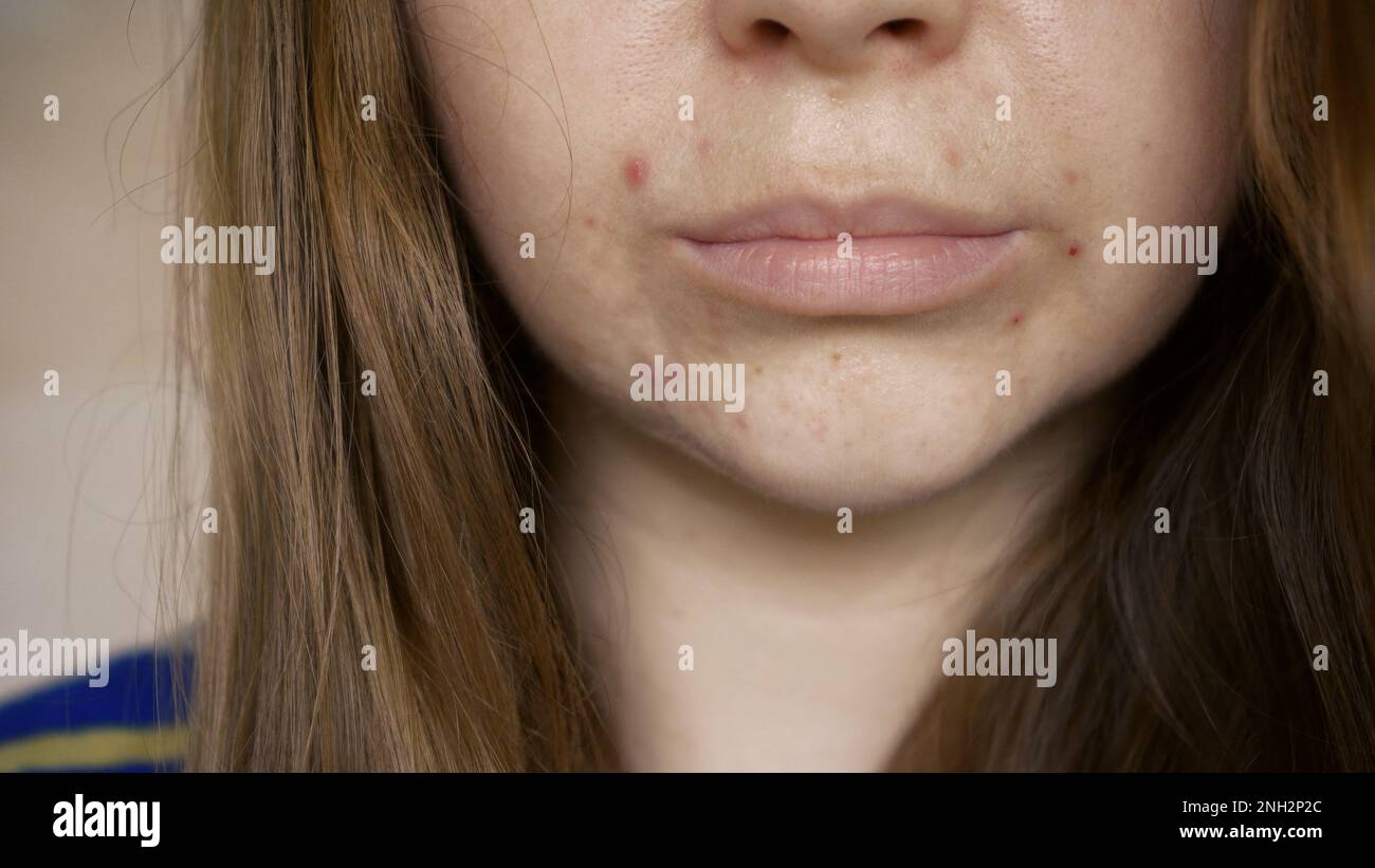 Close up of skin problems, unhealthy skin with acne and pimples. Porous ...