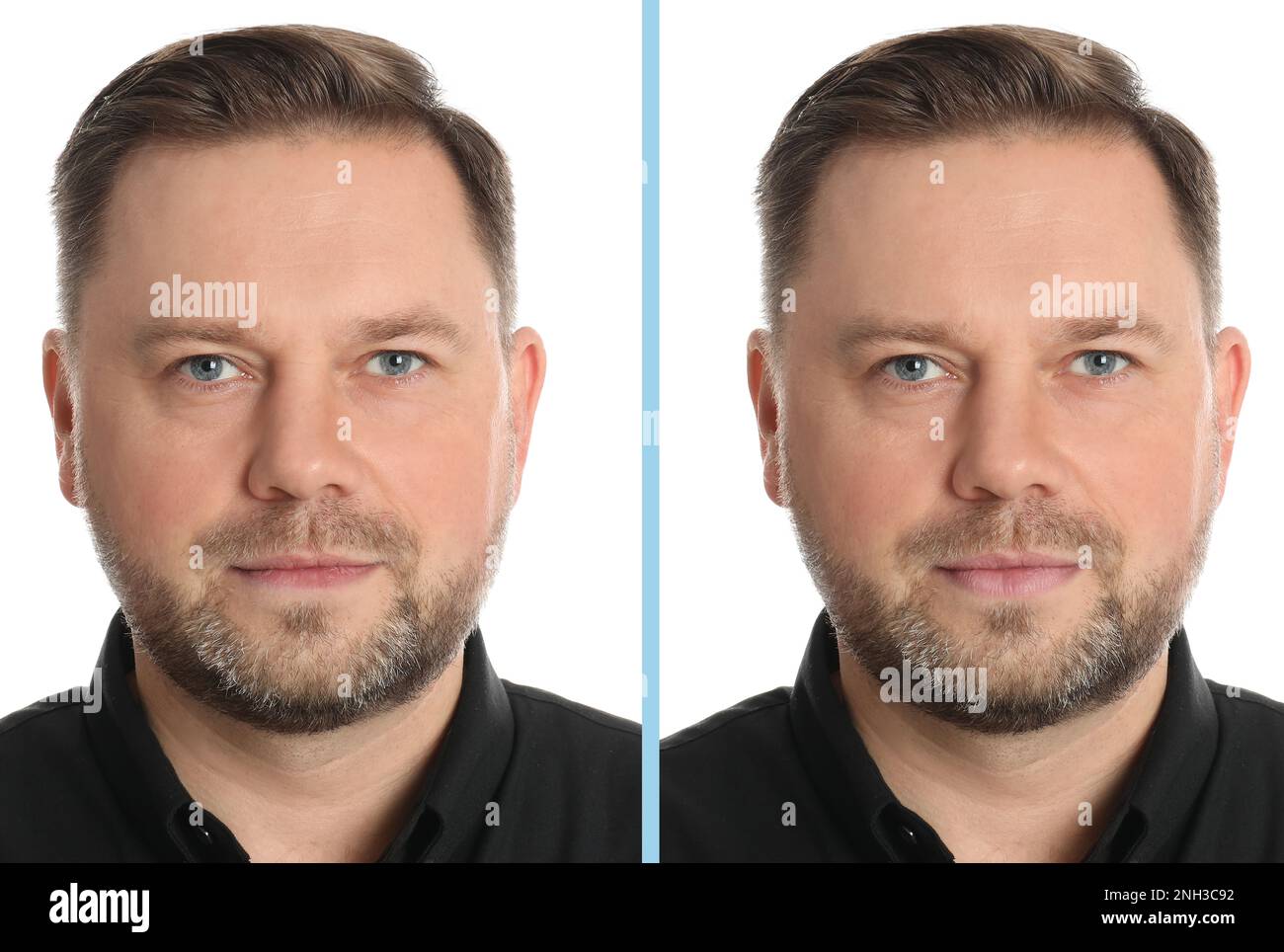 Collage with photos of man before and after lips augmentation Stock ...