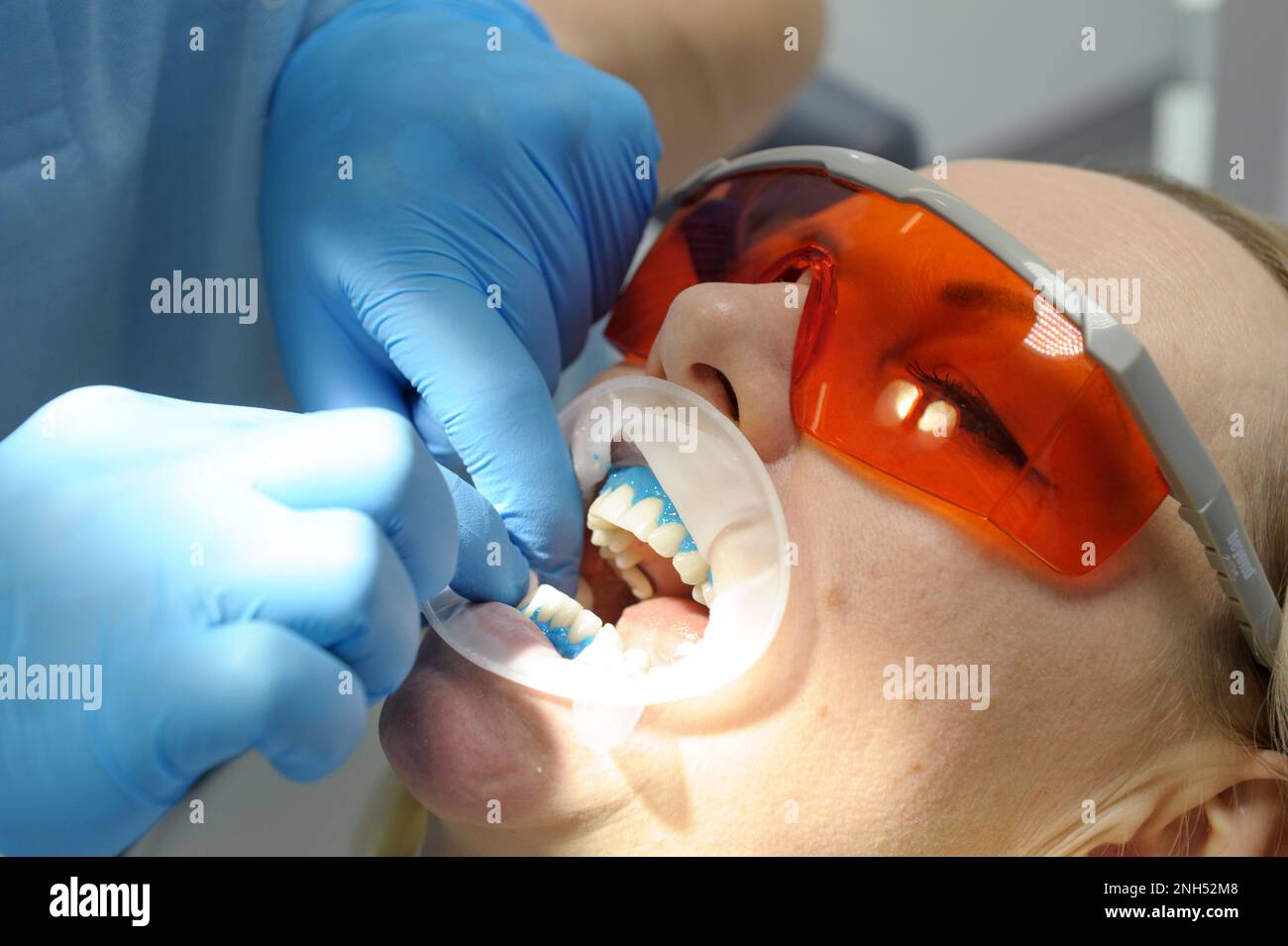 Optragate mouth dilator hi-res stock photography and images - Alamy