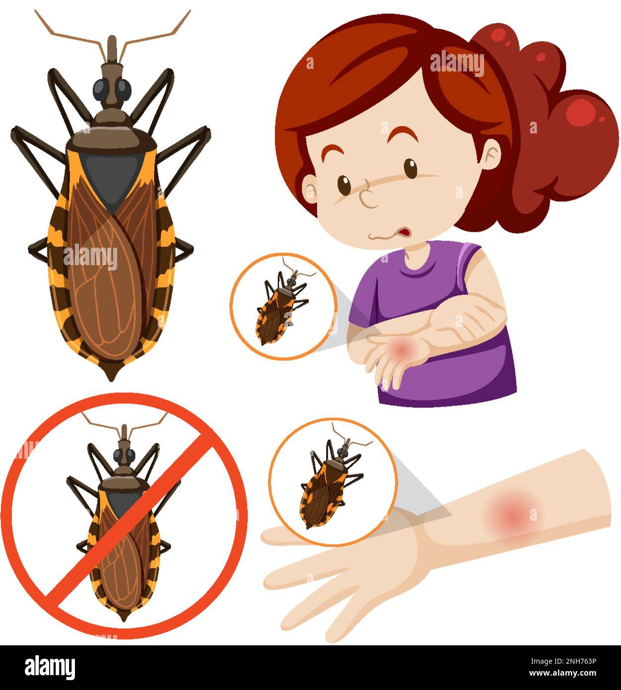 Human arm swollen from kissing bug bite illustration Stock Vector Image ...