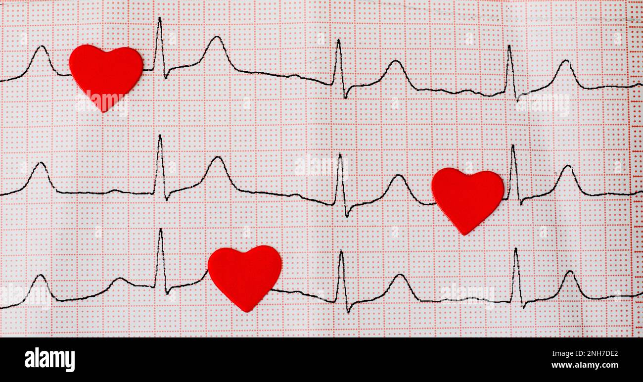 Ecg printout ventricular tachycardia hi-res stock photography and ...