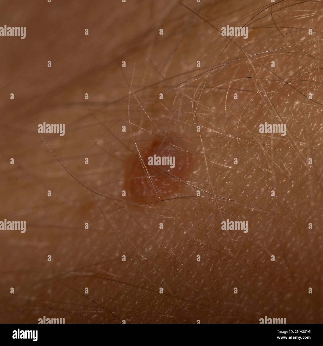 Skin cancer melanoma mole hi-res stock photography and images - Alamy