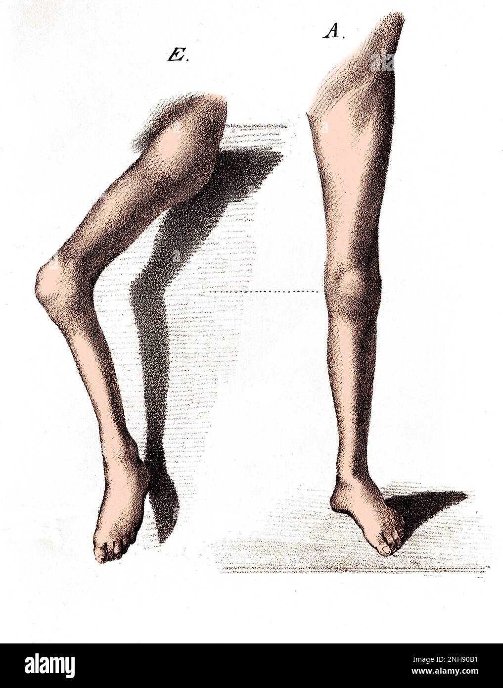 Polio leg Cut Out Stock Images & Pictures - Alamy