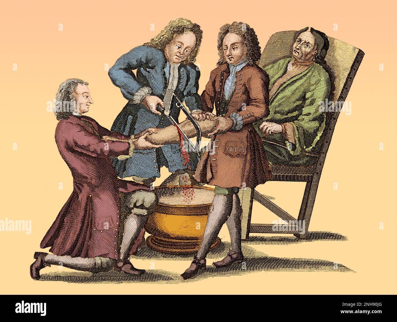 Medicine surgery amputation leg amputation hi-res stock photography and ...