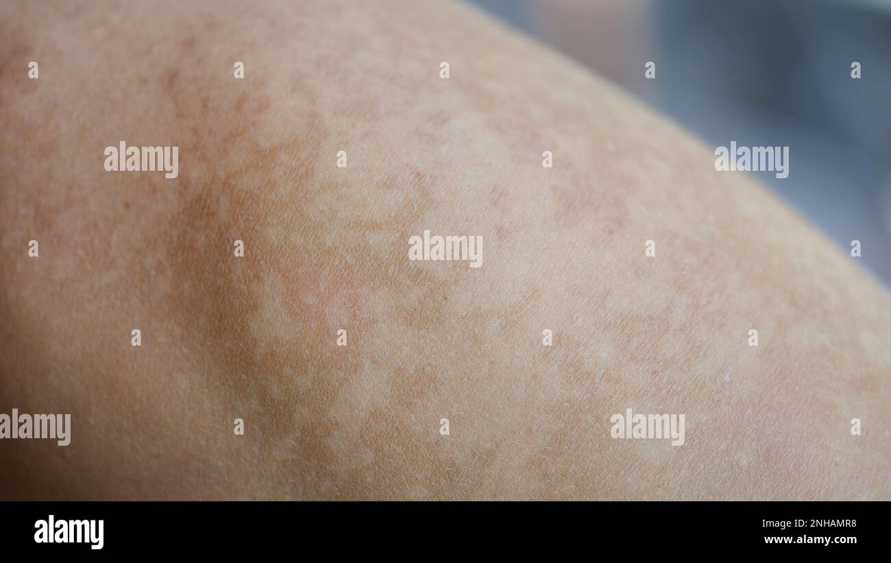 Macro part of the body is uneven pigmentation skin Stock Photo - Alamy