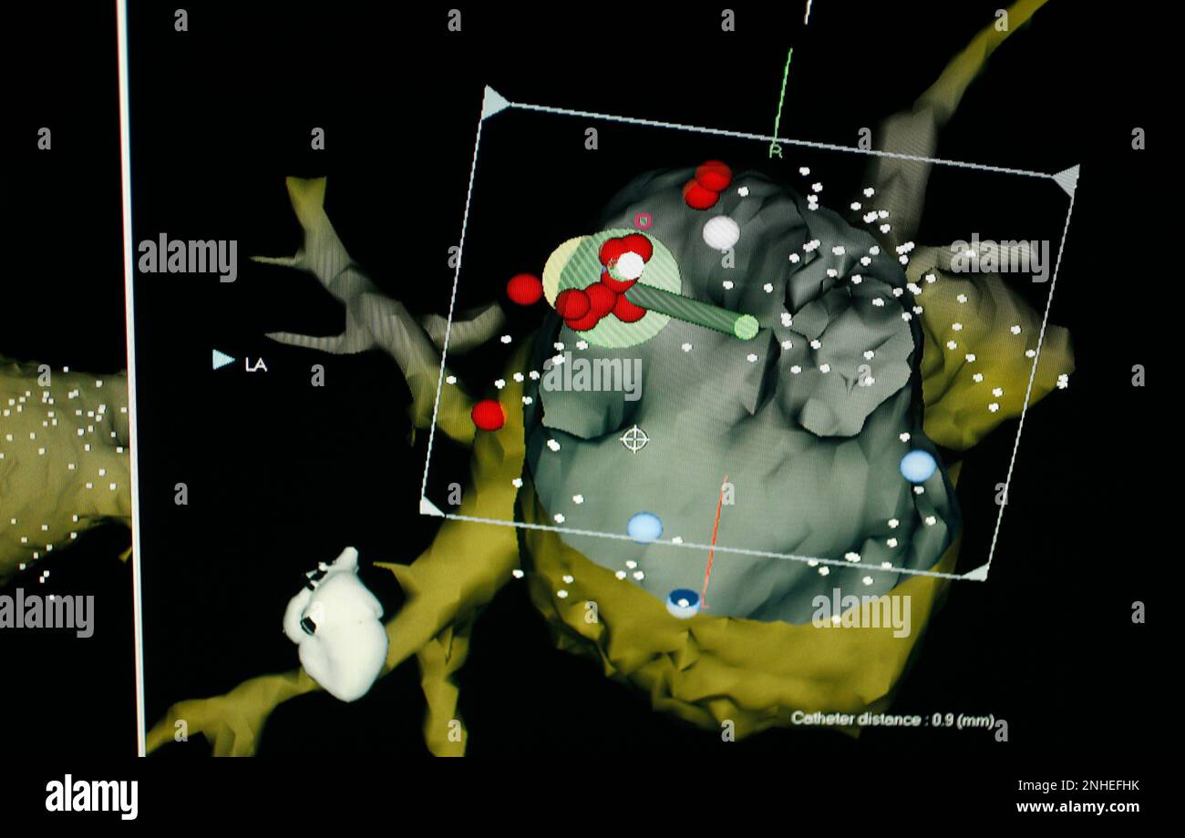 lifescience1-21-2007 0080 mac.jpg A catheter inside the heart of ...