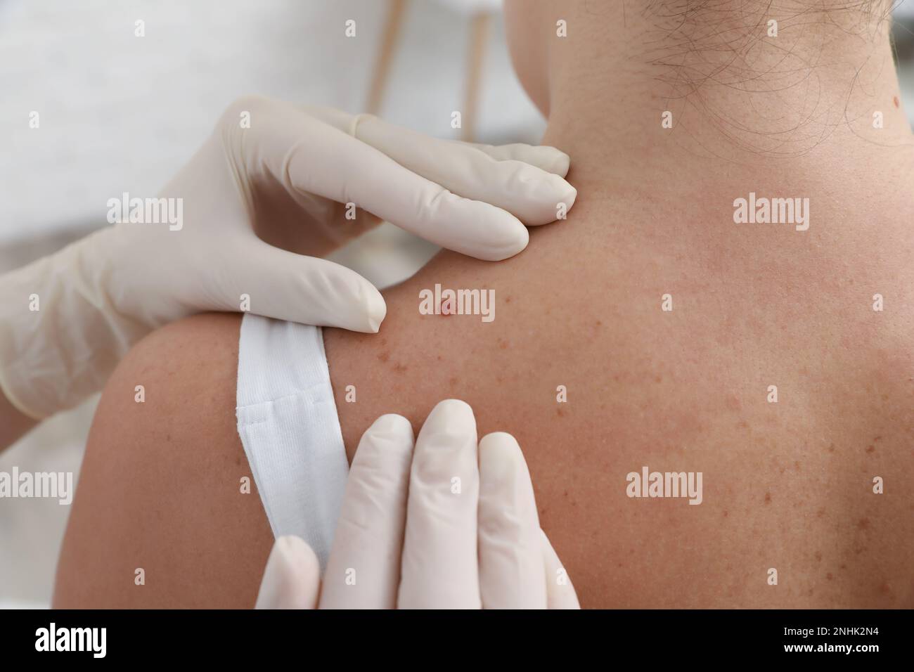 Dermatologist examining patient's birthmark in clinic, closeup Stock ...