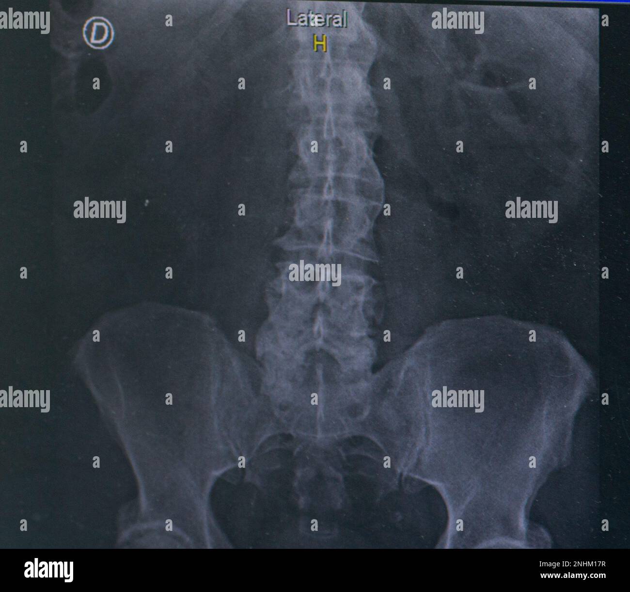 X-Ray plate Lumbar spine Vertebrae Stock Photo - Alamy