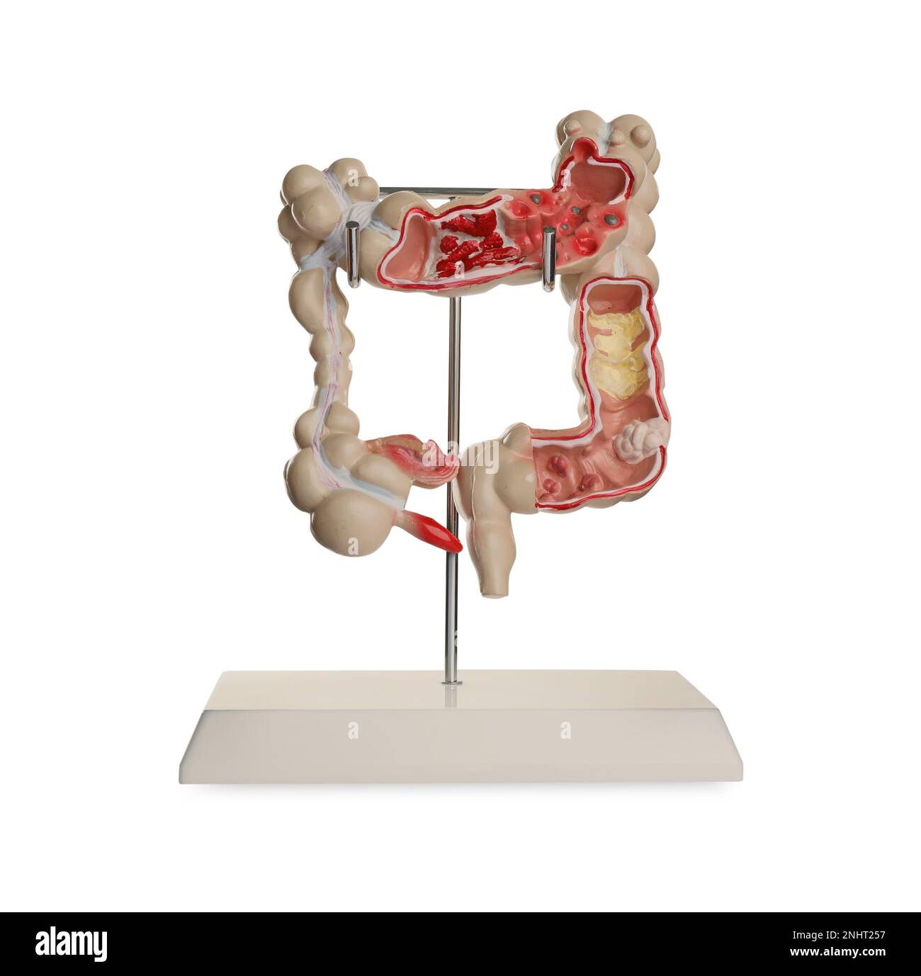 Anatomical model of large intestine isolated on white. Gastroenterology ...