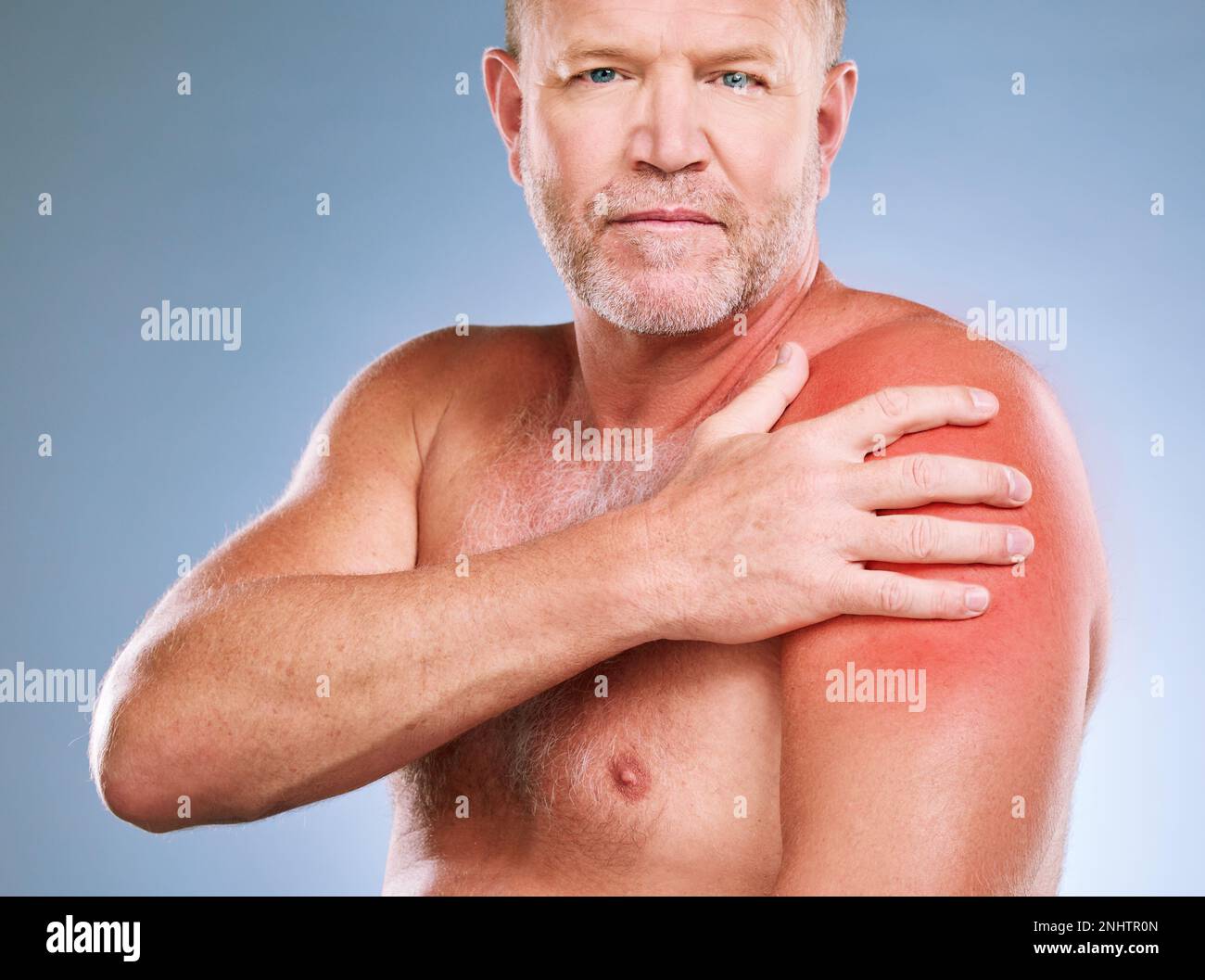 Sunburn, skincare and portrait of a man with red skin color and burn ...