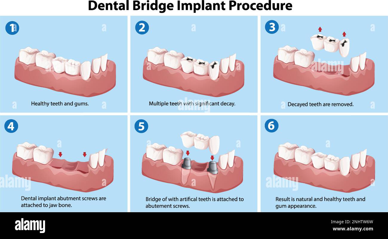 Dental Implant Bridge Procedure at Adam Talbert blog