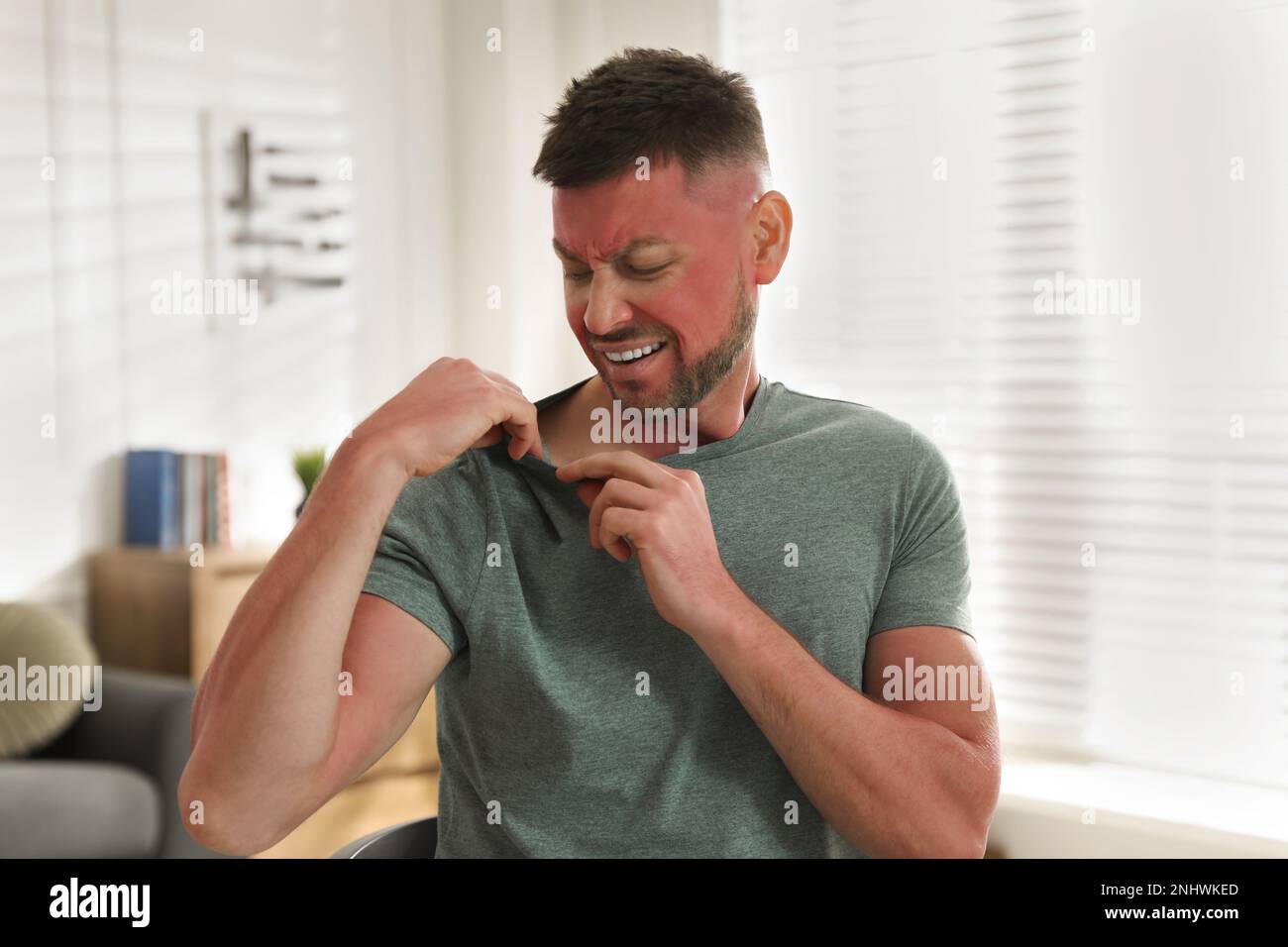 Man with sunburn on skin at home Stock Photo - Alamy