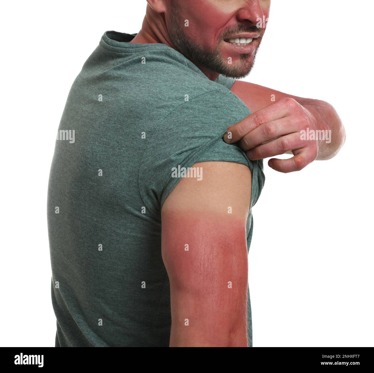 Man with sunburned skin on white background, closeup Stock Photo - Alamy