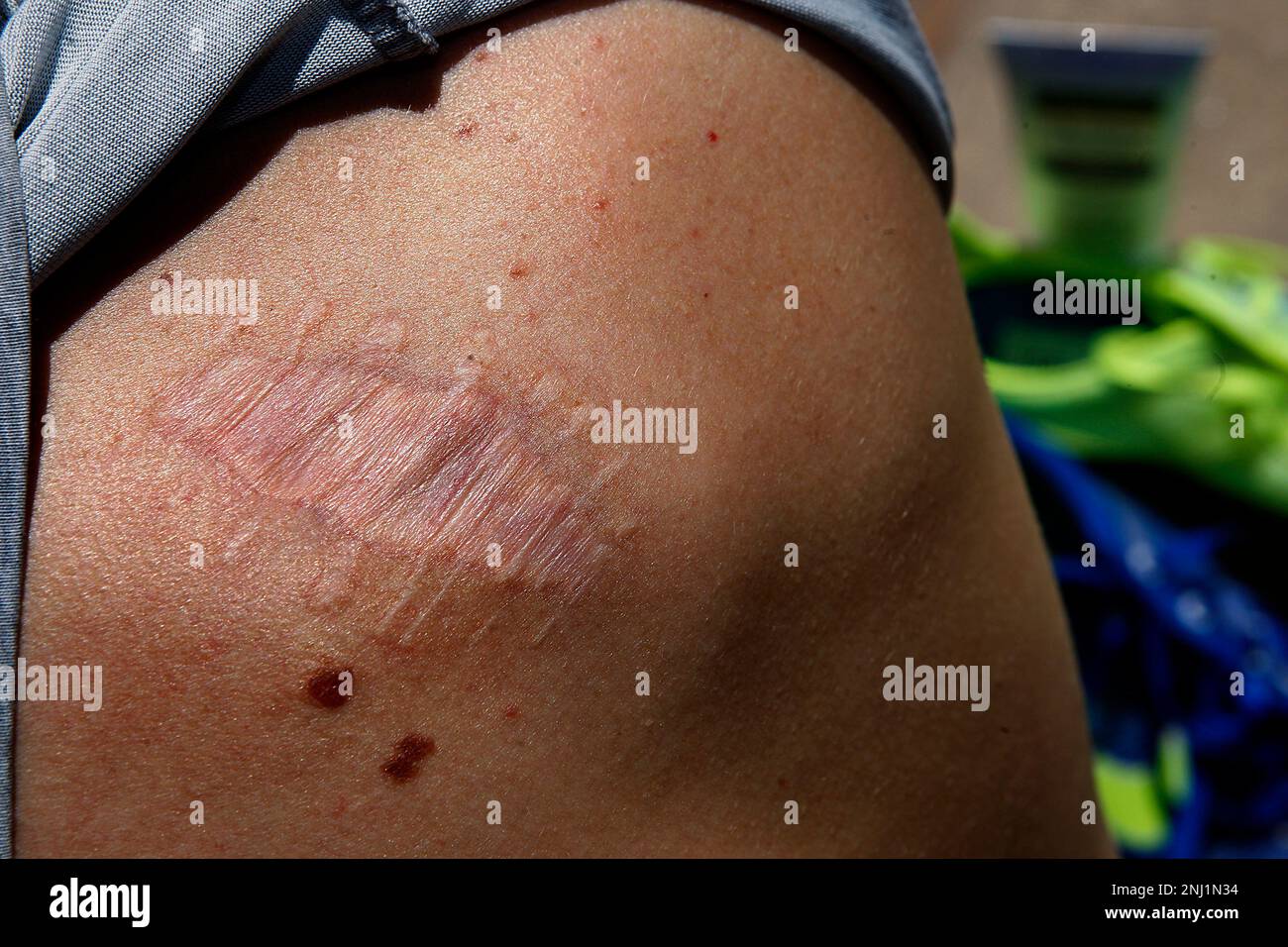 Stanford track member Erik Olson shows the skin cancer scar on his back ...