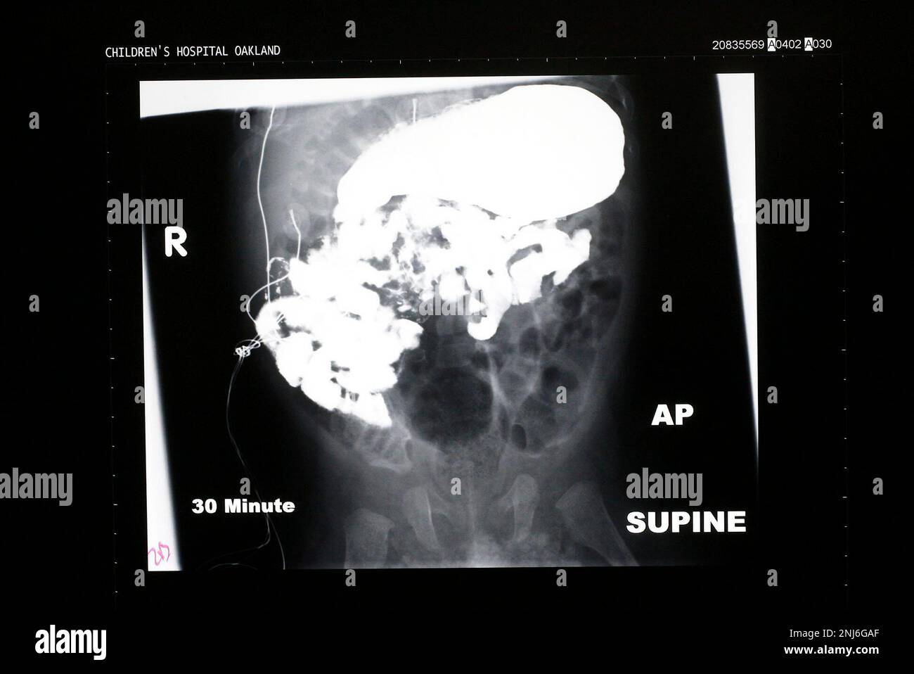 Stomach Turned Upside Down