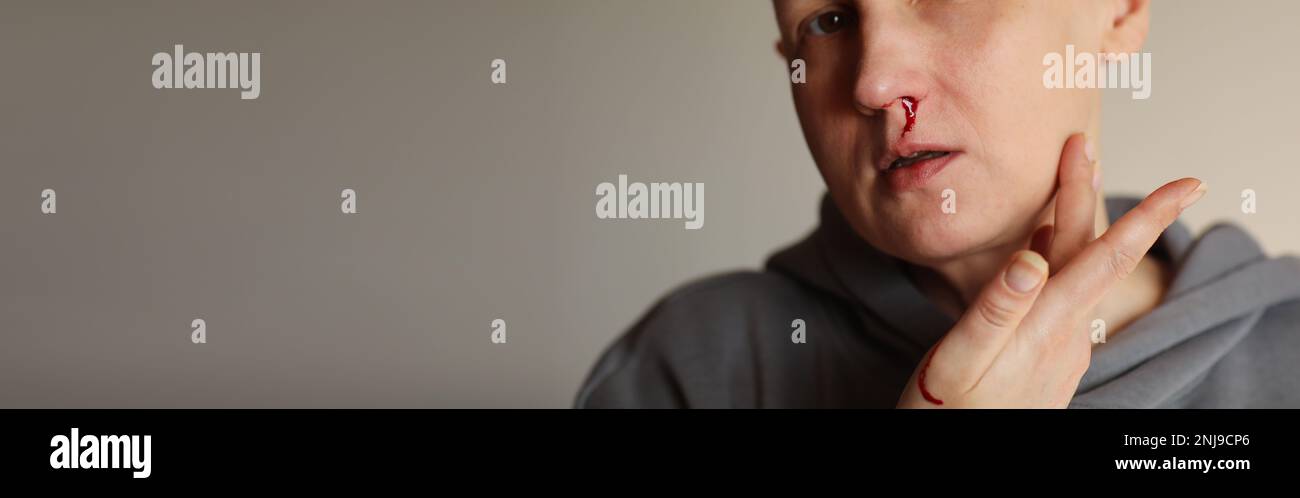 Banner Hairless cancer sick female patient is bleeding from her nose ...