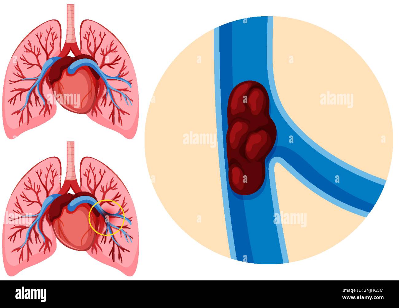 Human Anatomy Pulmonary Embolism Illustration Stock Vector Image And Art