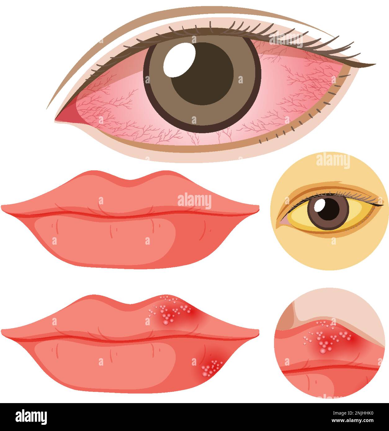 Jaundice disease vector concept illustration Stock Vector Image & Art ...