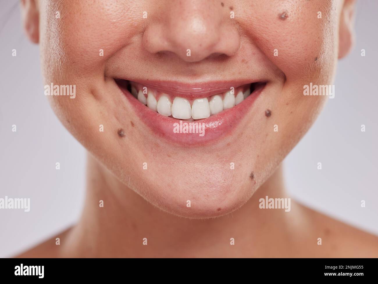 Closeup, teeth and woman with dental care, cosmetics and treatment ...