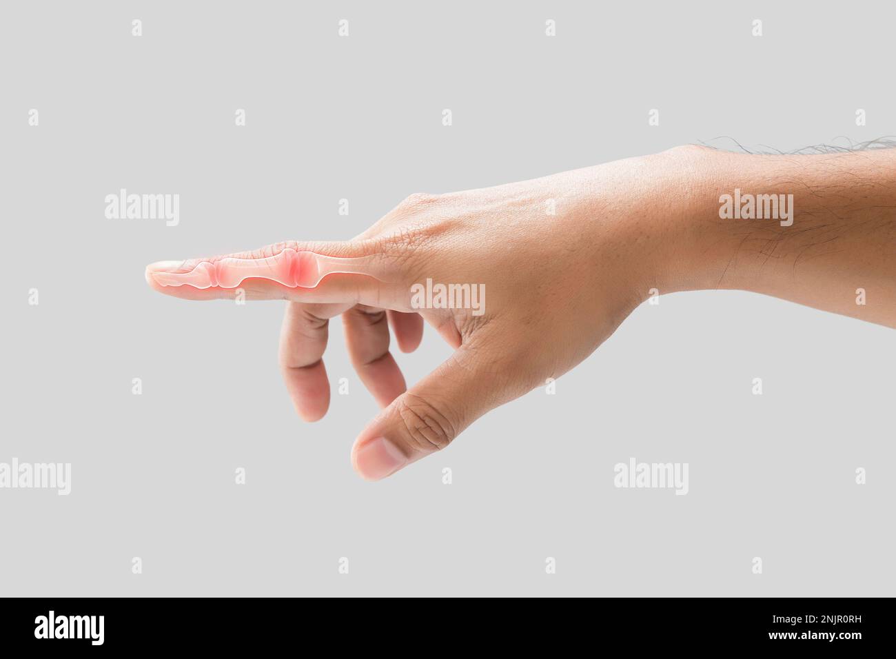 Inflammation of the index finger and synovial joint. on a gray ...