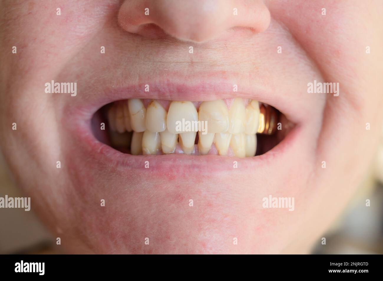 Close-up photo of natural looking teeth of a aged woman Stock Photo - Alamy