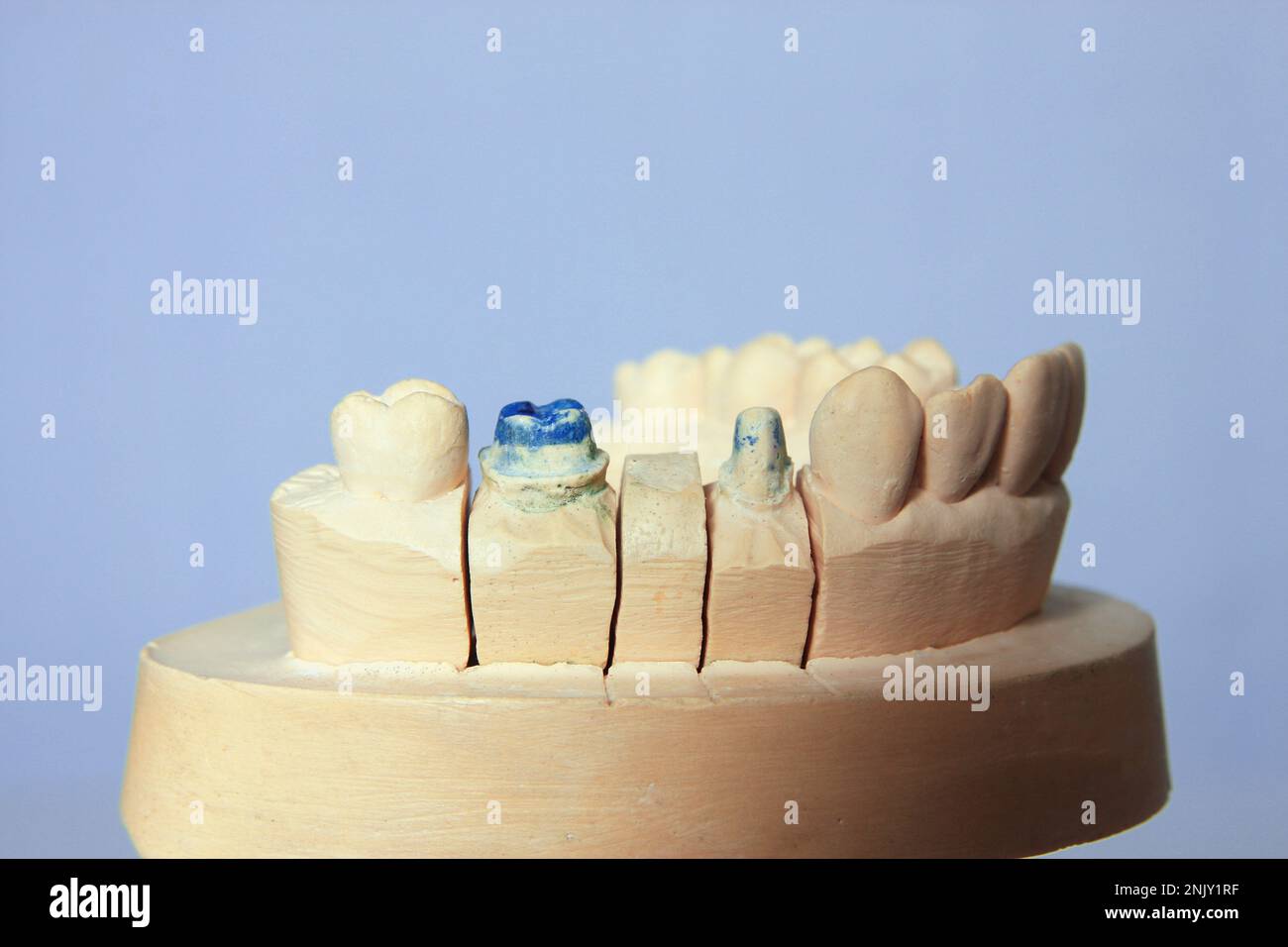 plaster cast for dental bridge Stock Photo - Alamy