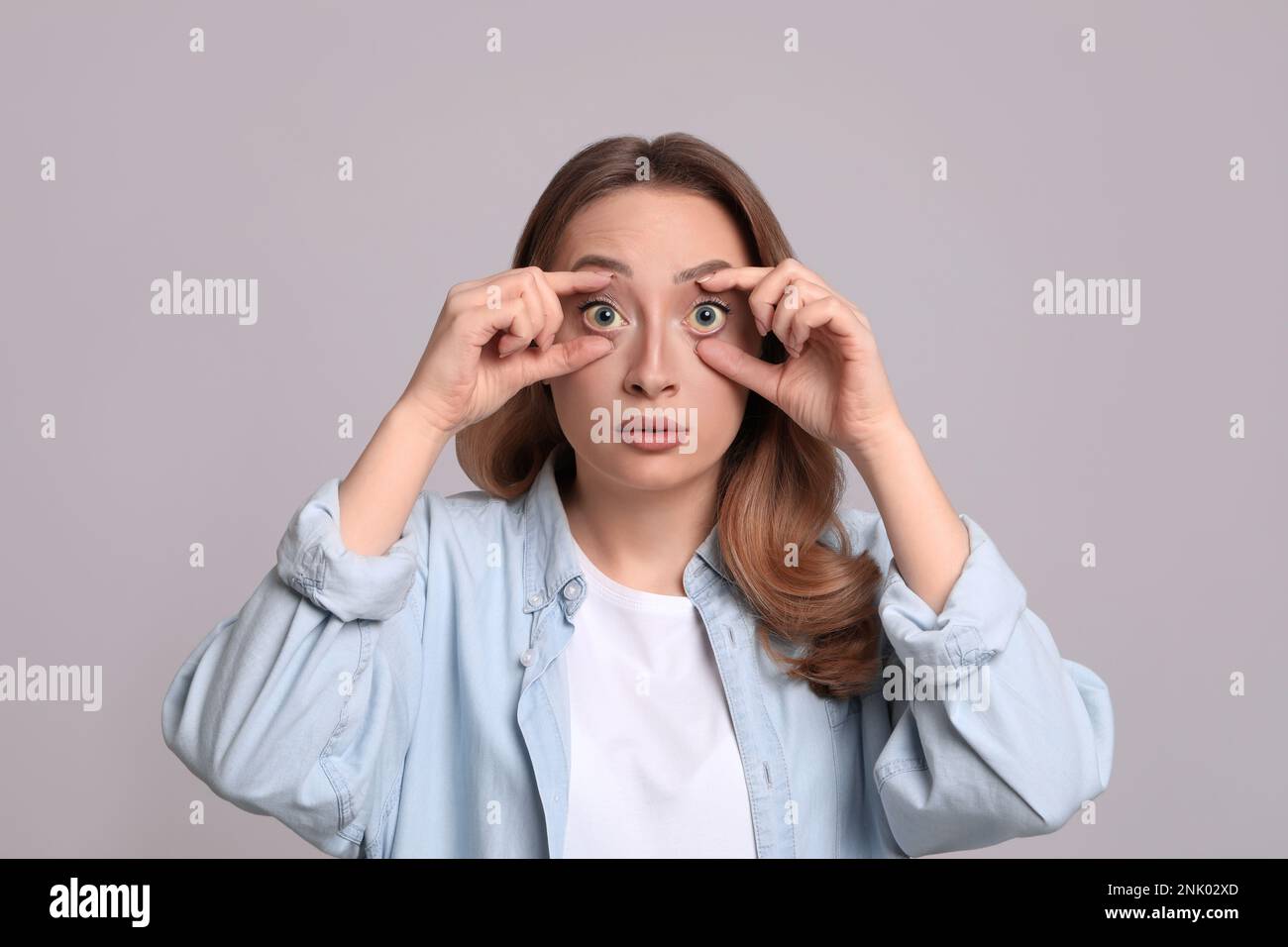 Woman With Yellow Eyes On Grey Background Liver Problems Symptom Stock