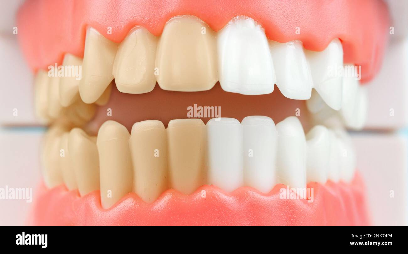 Clean and dirty tooth before and after whitening. Dentistry conceptual ...