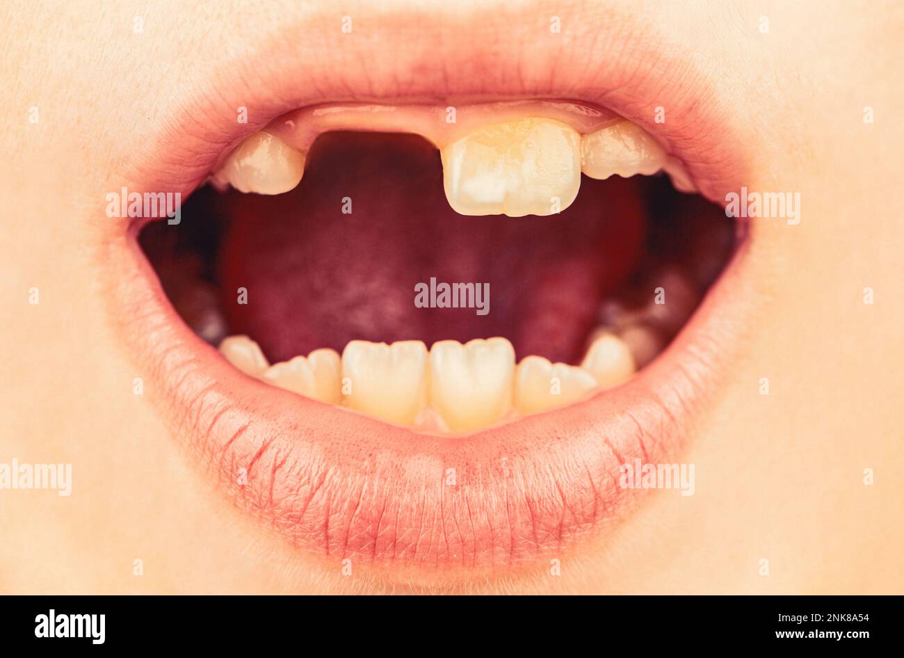Bad teeth child. Portrait boy with bad teeth. Close up of unhealthy ...