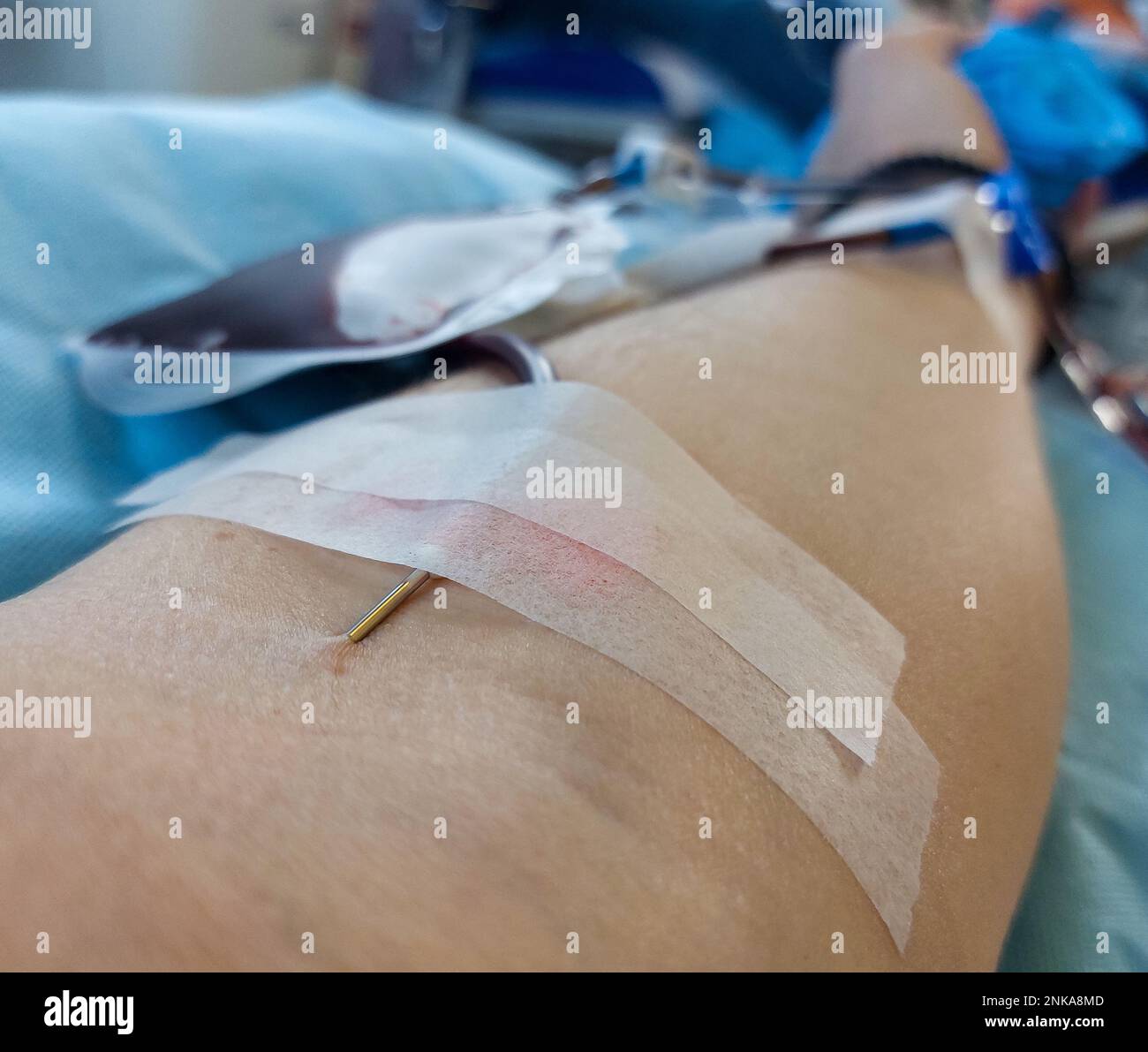 needle stuck in blood young person arm during blood transfusion at ...
