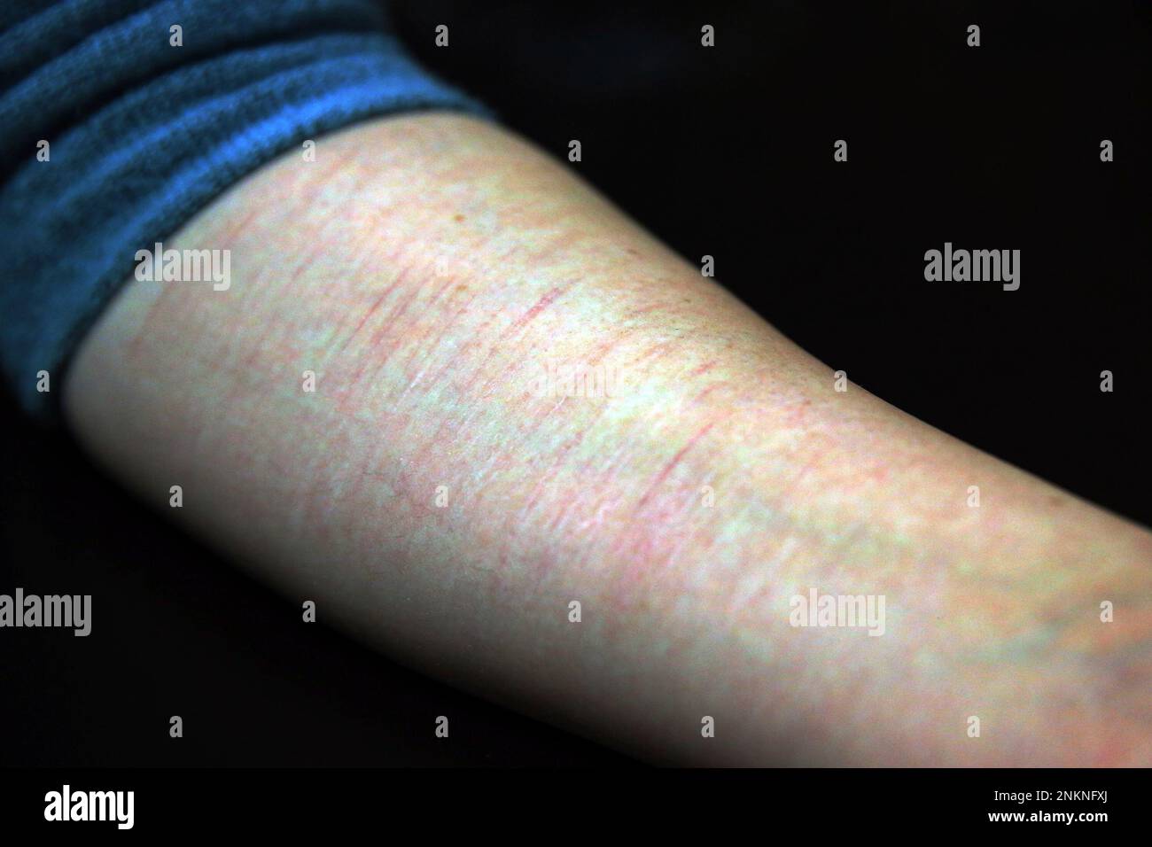 Scars from self-harm are visible on B's arm. The 16-year-old was ...