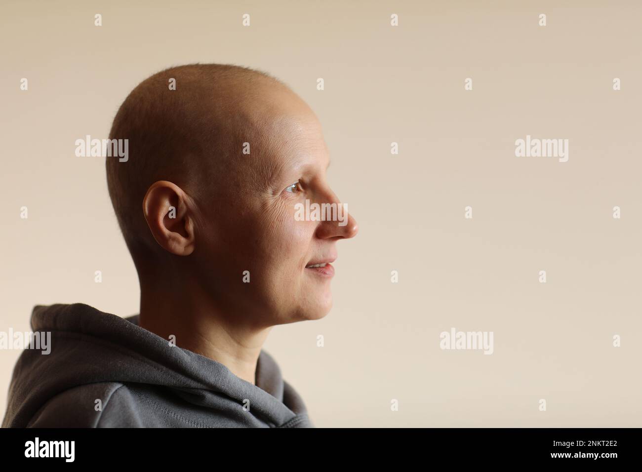 Effects of chemotherapy. Portrait of funny face millennial hairless ...