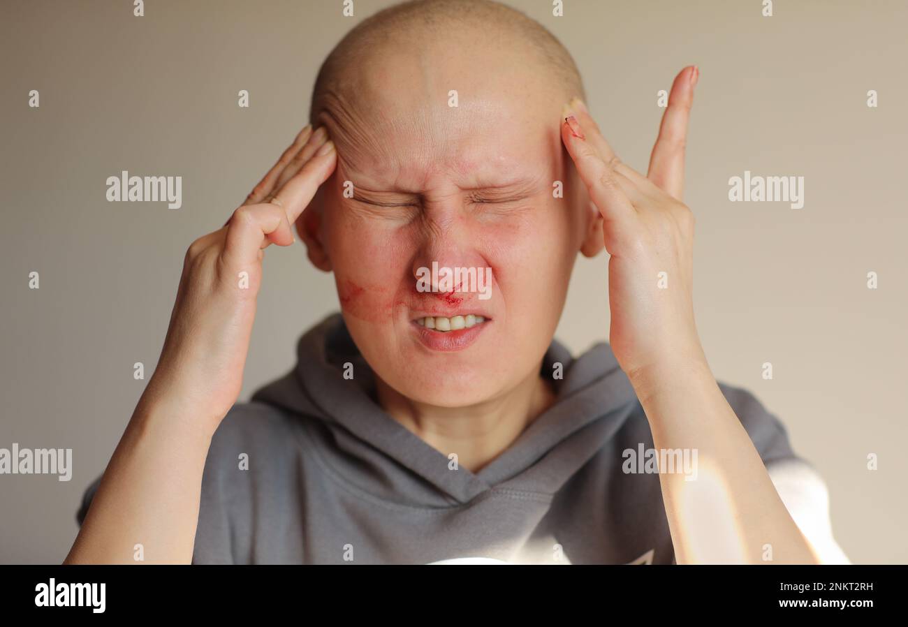 Bald cancer sick woman is bleeding from her nose, effects of ...