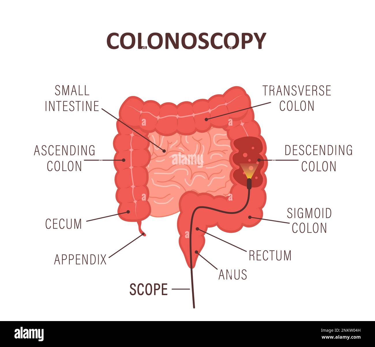 Colonoscopy concept. Intestine exam and treatment. Bowel polypectomy ...