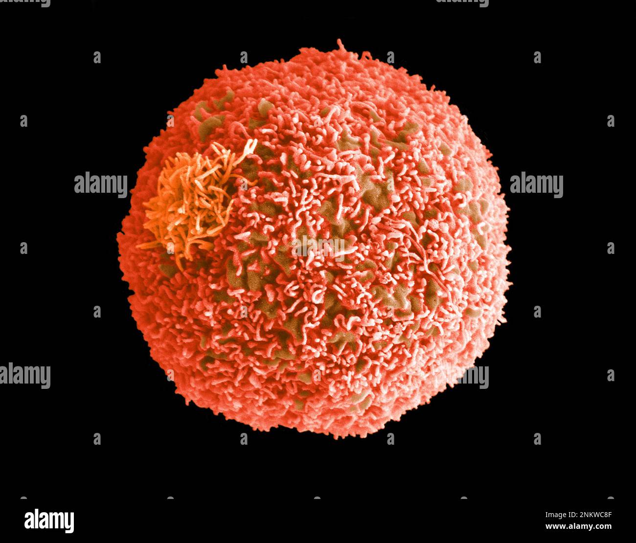 Lung cancer cell, SEM Stock Photo - Alamy