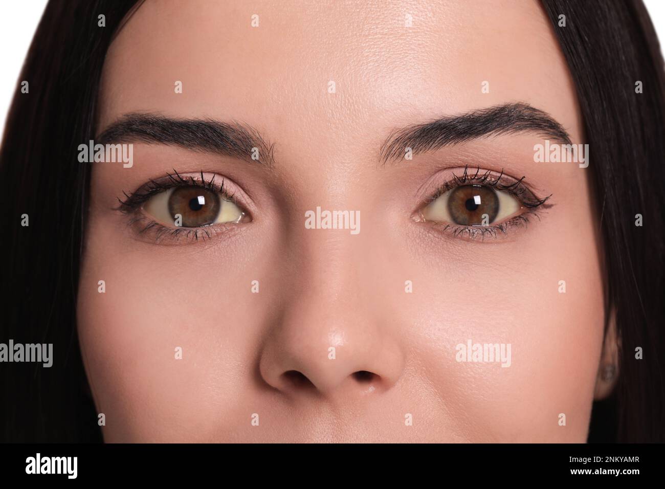 Woman with yellow eyes as background, closeup. Liver problems symptom ...