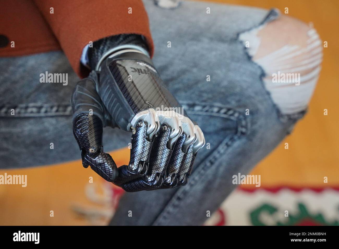 Amputated arm accident hi-res stock photography and images - Alamy