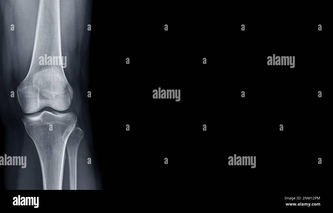 Film x-ray of Left knee joint AP view for medical background Stock ...