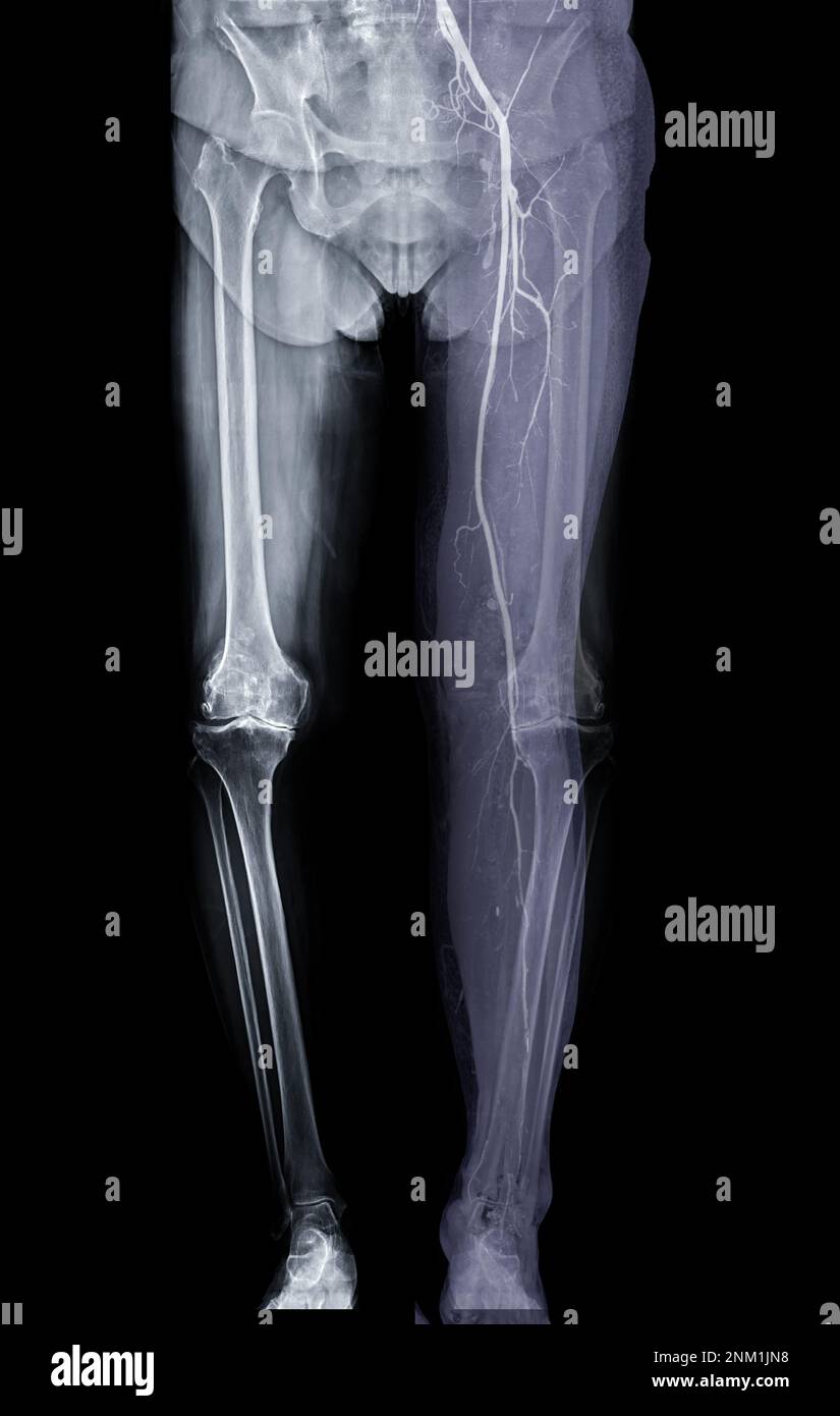 Scanogram image fusion with CTA lower extremities Stock Photo - Alamy