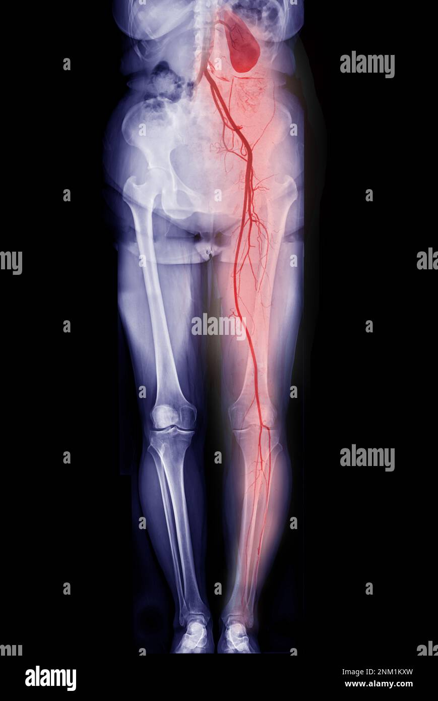 CTA femoral artery run off showing femoral artery for diagnostic Acute ...