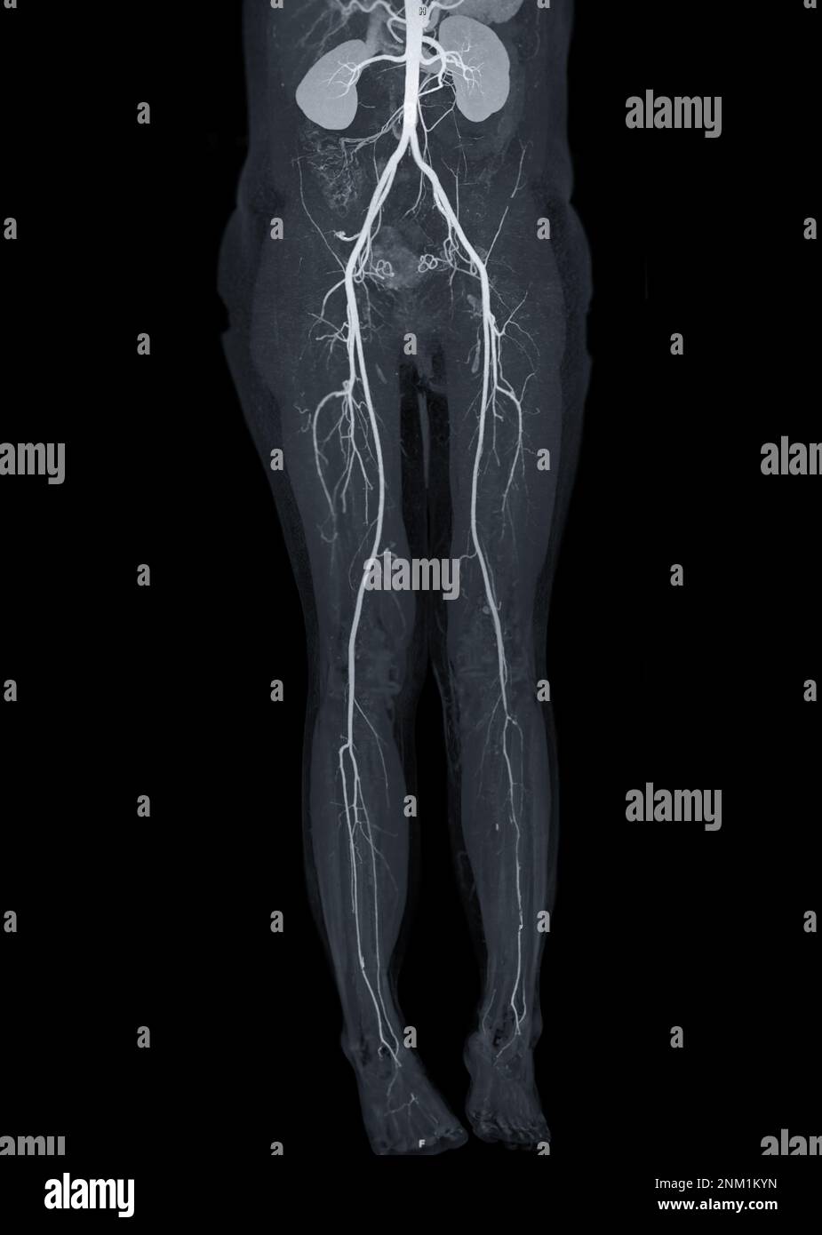 CTA femoral artery run off showing femoral artery for diagnostic Acute ...
