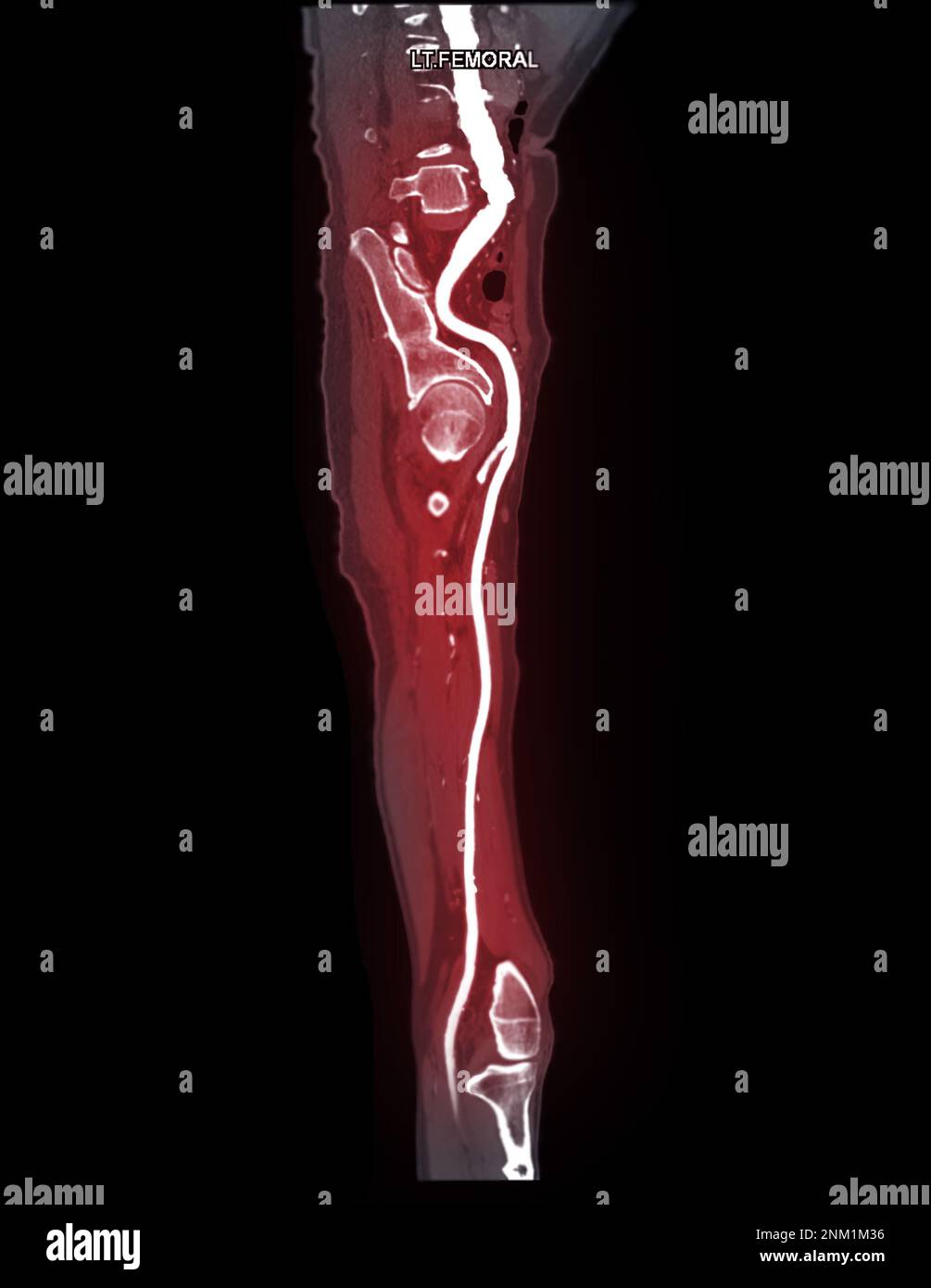CTA femoral artery run off MPR curve showing Left femoral artery for ...