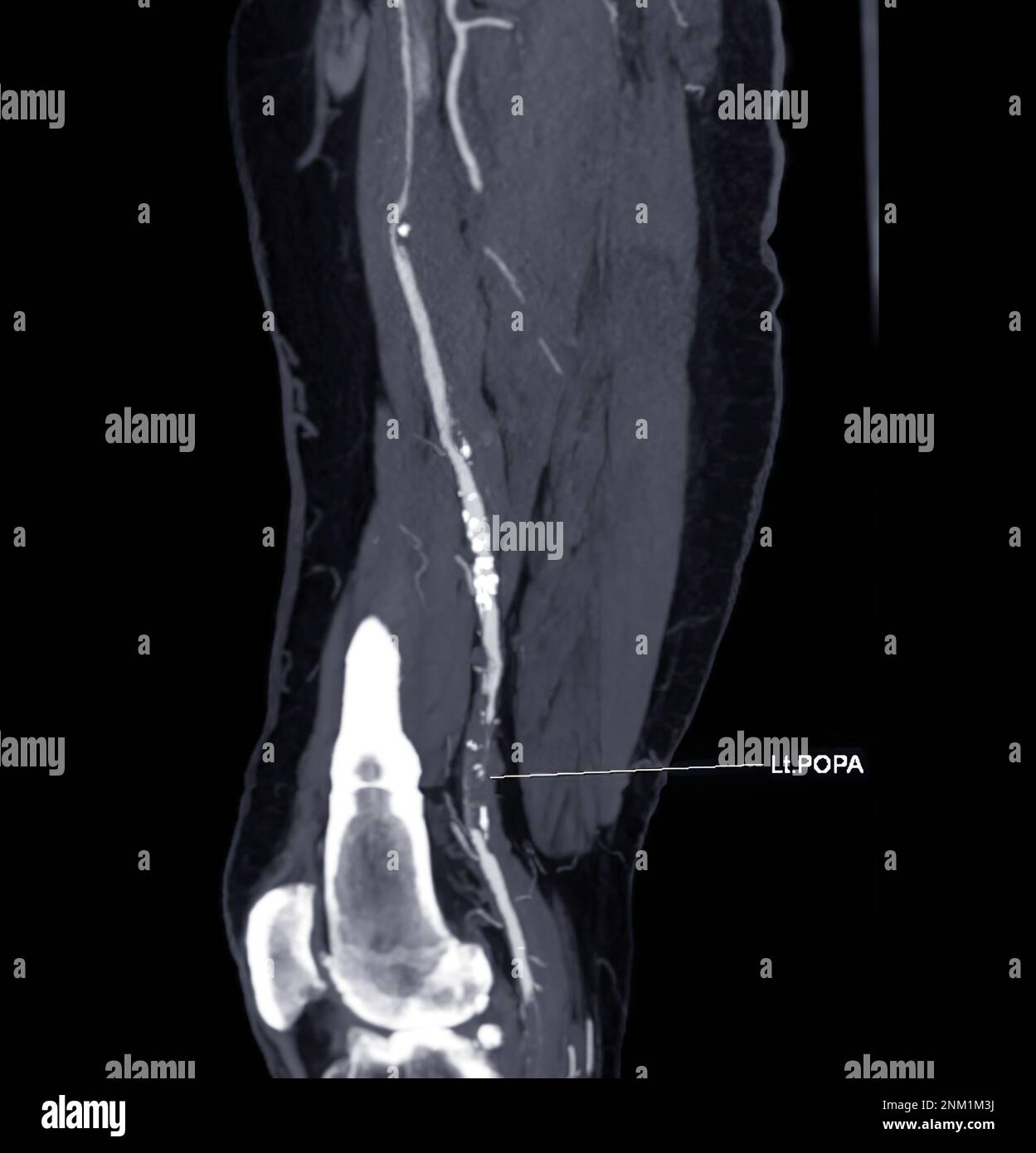 CTA femoral artery run off MPR curve showing Left femoral artery for ...