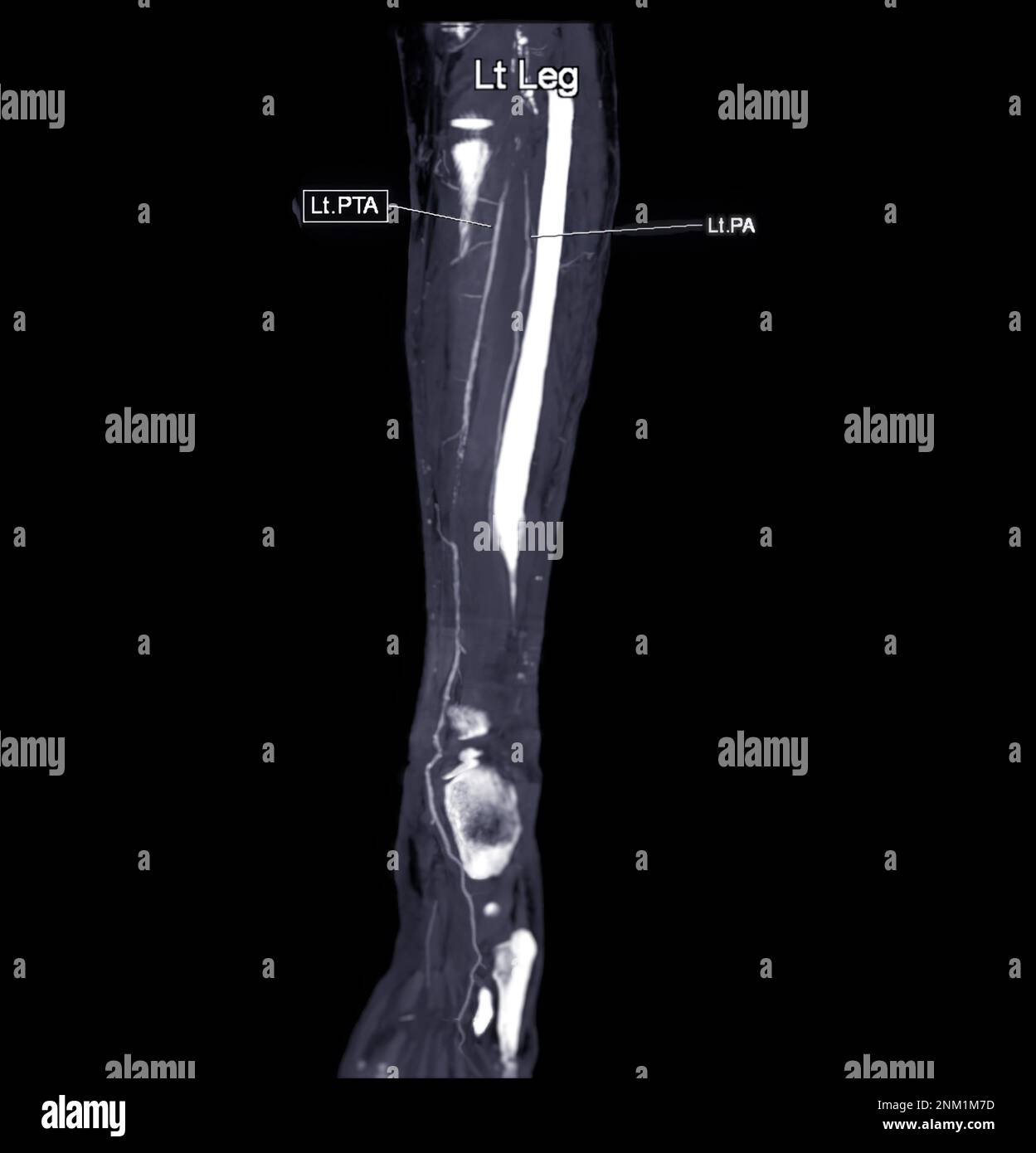 CTA femoral artery run off MPR curve showing Left femoral artery for ...