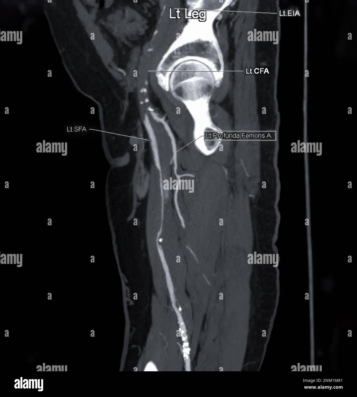 CTA femoral artery run off MPR curve showing Left femoral artery for ...